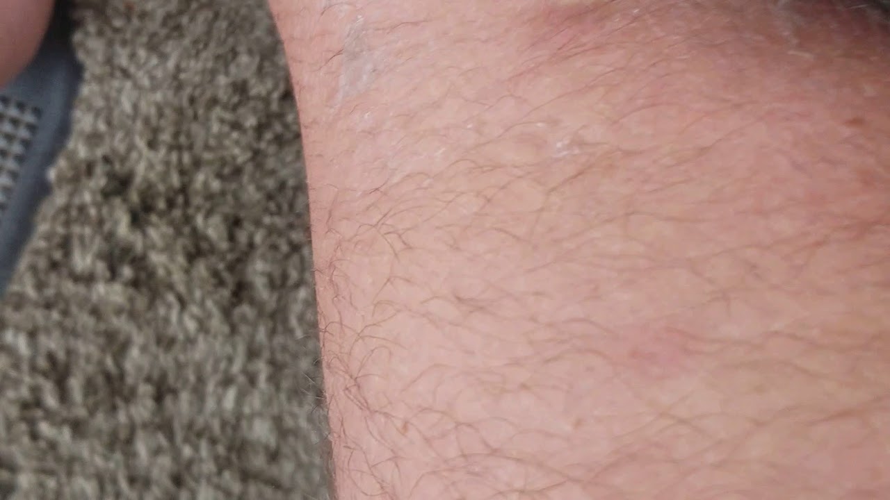 When u get sunburn and about to peel. This is the easiest way - YouTube