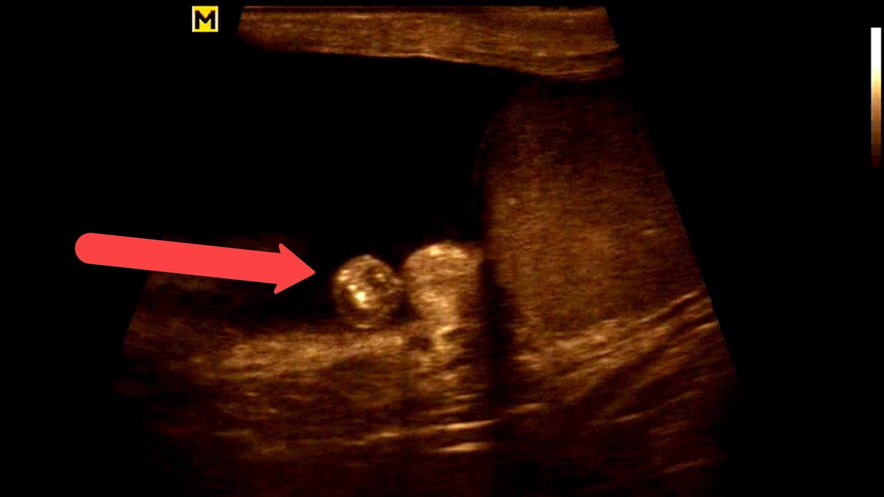 Ultrasound cases 54 of 2000 || Video Showing calcification Appendix ...