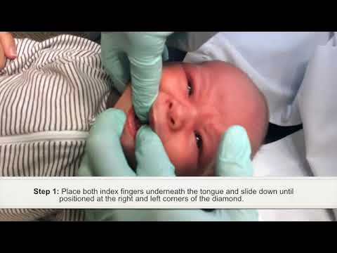 Frenectomy Home Care 1 - YouTube