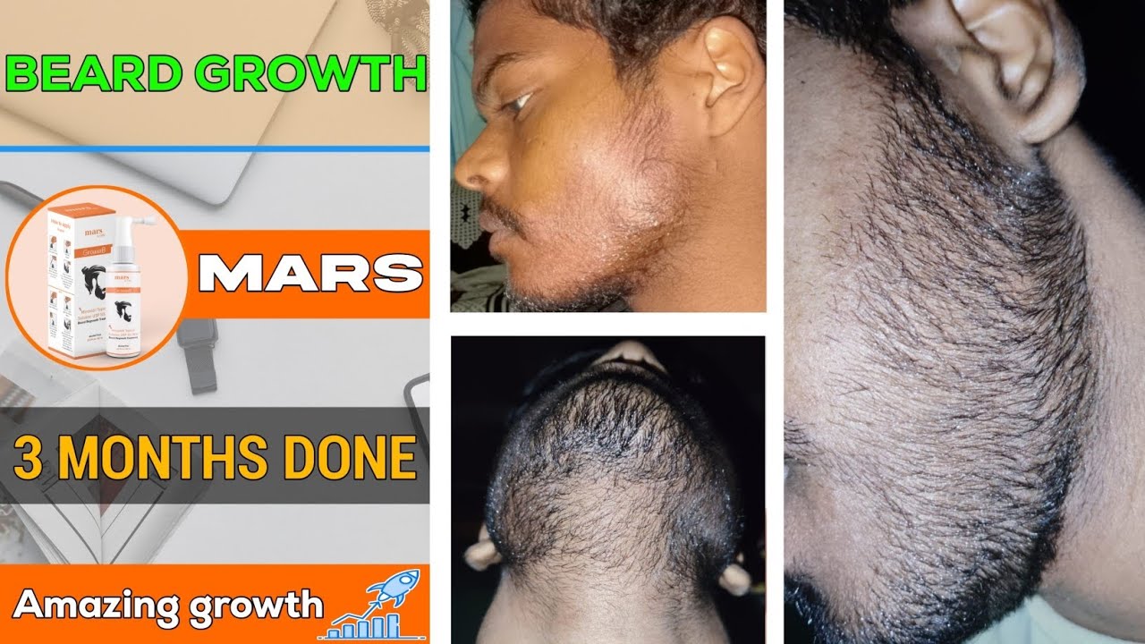 BEARD GROWTH || 3 months done ️ Amazing beard growth from minoxidil ...