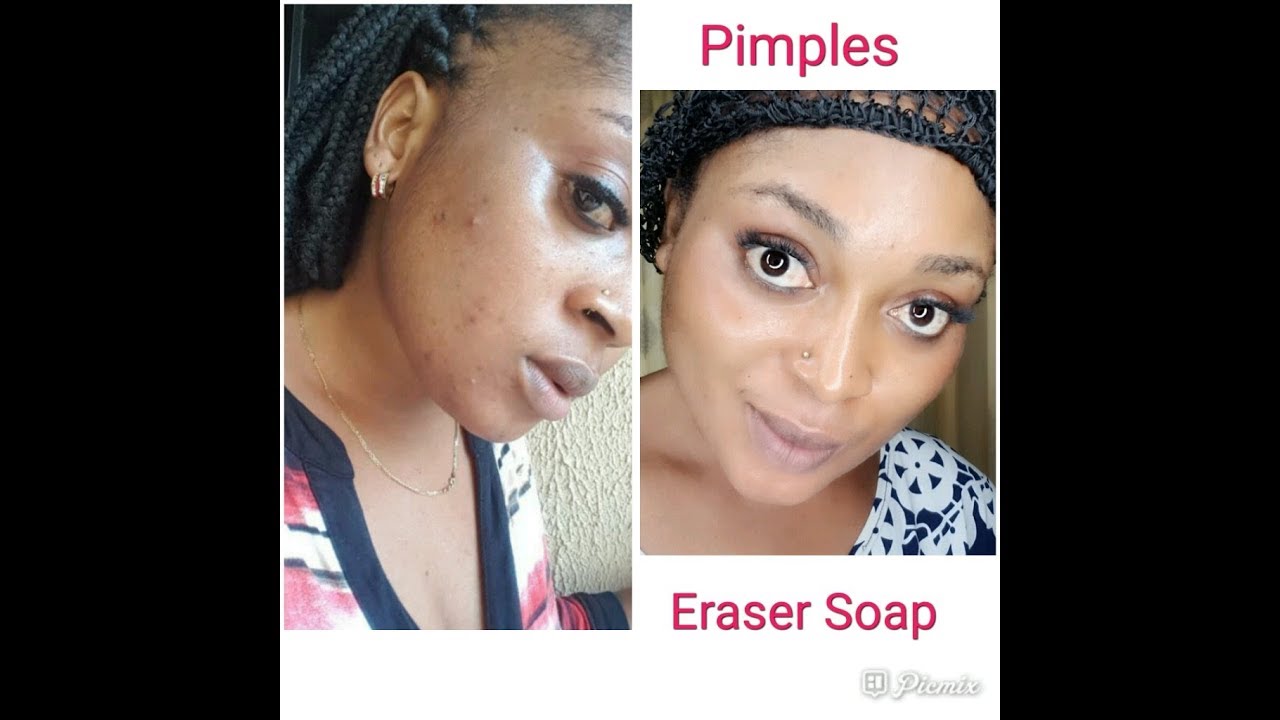 How To Make Pimples Eradicator Soap|| How To Remove Pimples Fast | Acne ...