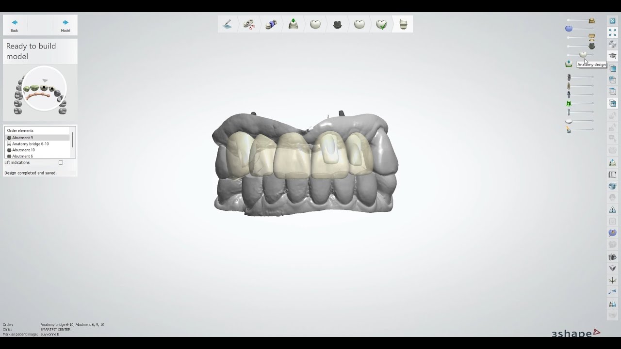 3shape design implant bridge #6-10 - YouTube
