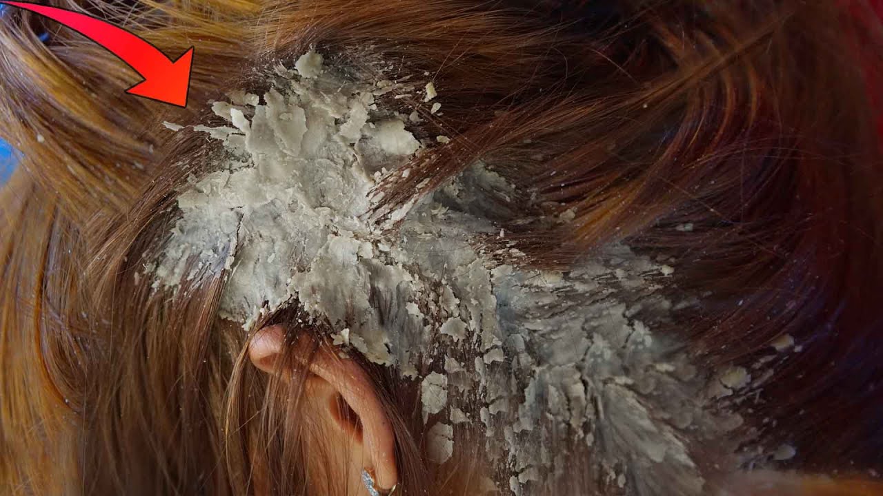 DANDRUFF SCRATCHING BIG FLAKE!! satisfying and picking on beautiful ...