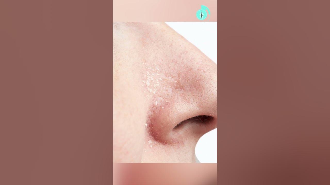 Reason Of Dry Skin Around Nose Dry reason-of-dry-skin-around-nose-dry