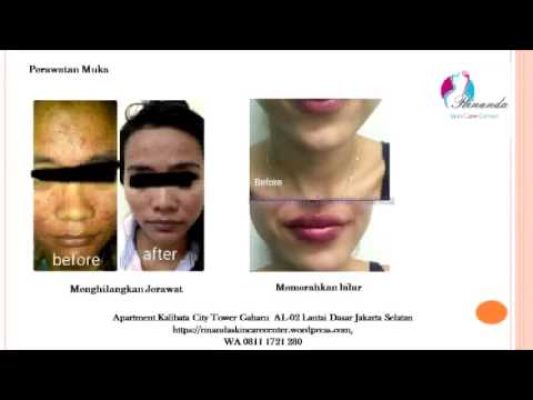 0811 1721 280, Biar Payudara Besar di Rawamangun F2 Beauty Clinique