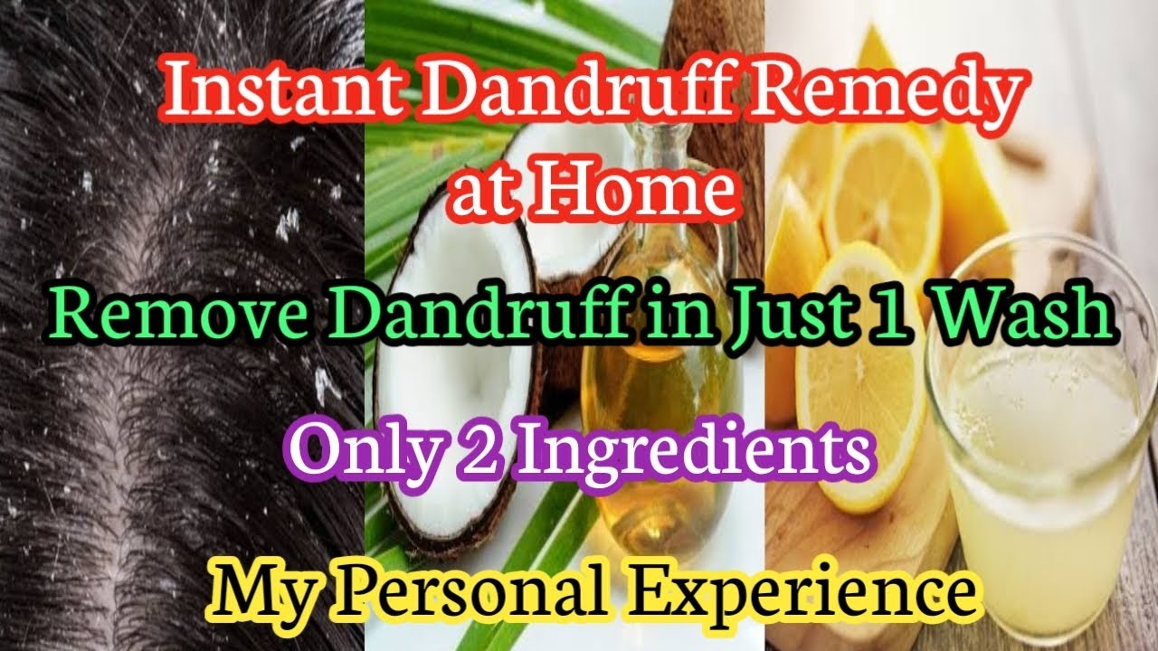 Instant Dandruff Remedy at Home | Remove Dandruff in Single Wash | 2 ...