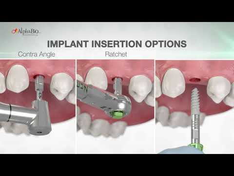 What Is Alpha Bio Dental Implant Abutment