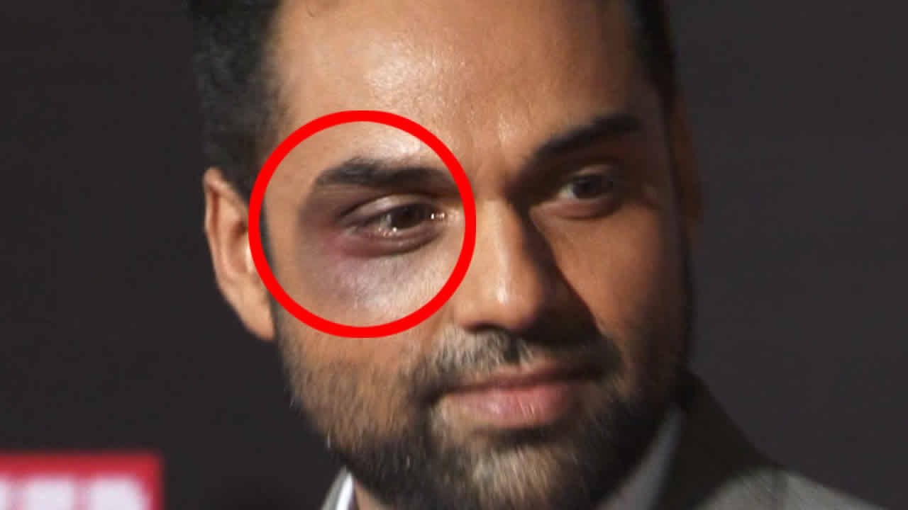 Reason Behind Abhay Deol's Punched Eye ! - YouTube