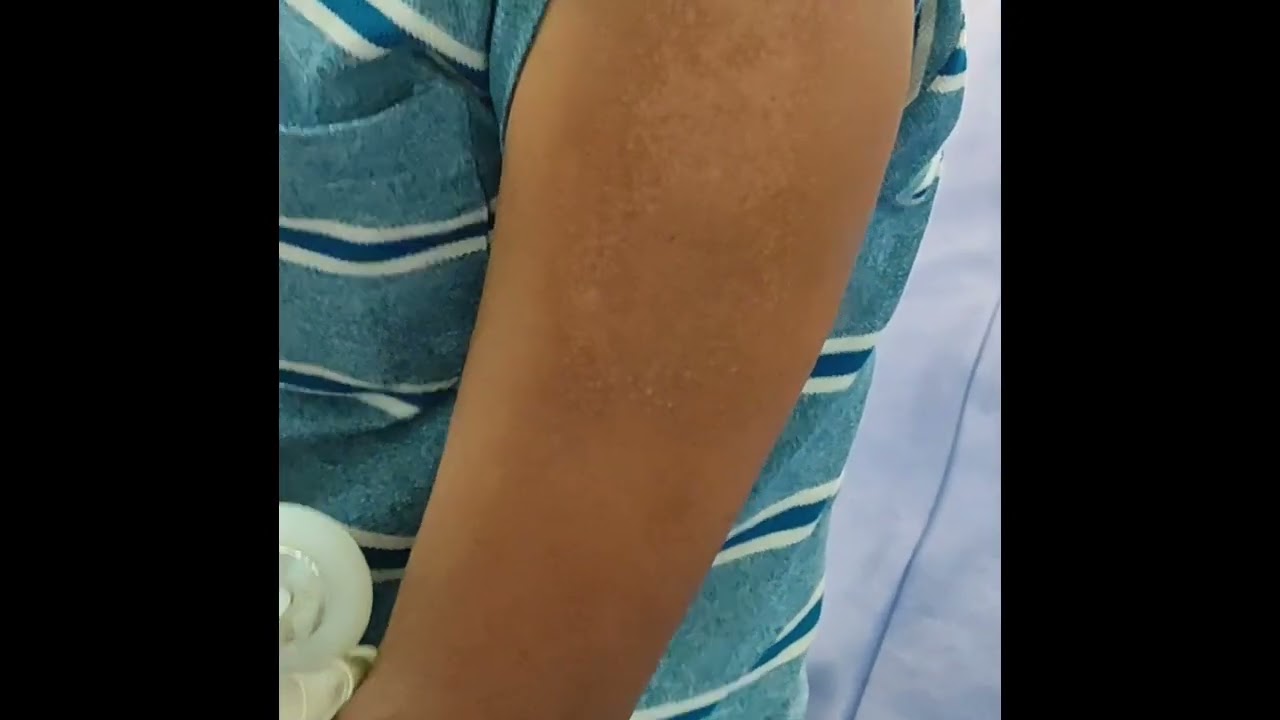 Biceps Deep Tendon Reflex and inverted biceps reflex by neurozone ...