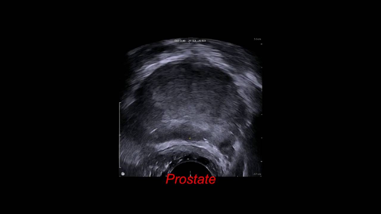 Trans Rectal Ultrasound - YouTube