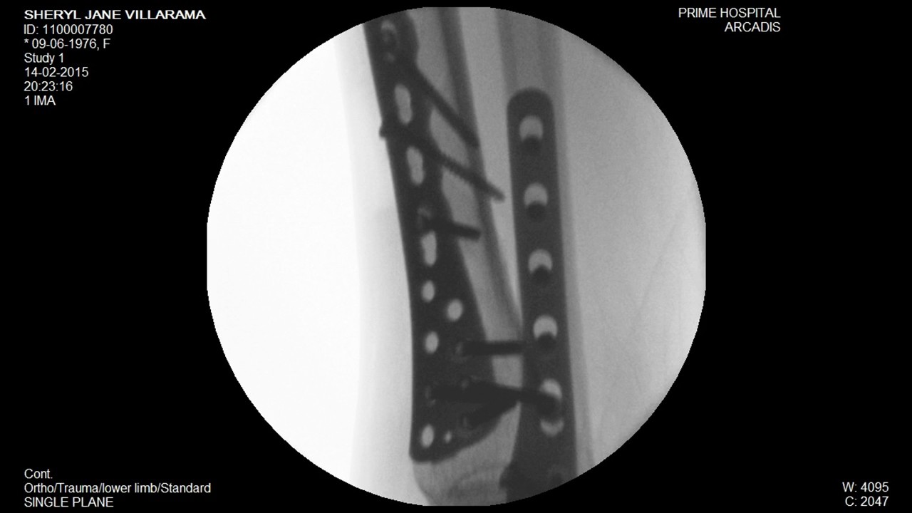 DISTAL TIBIA FRACTURE MIPO TECHNIQUE - YouTube