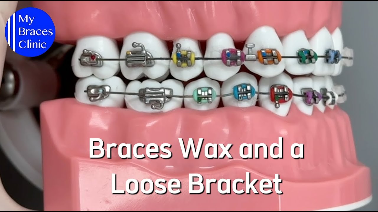 Braces Wax and a Loose Bracket - YouTube