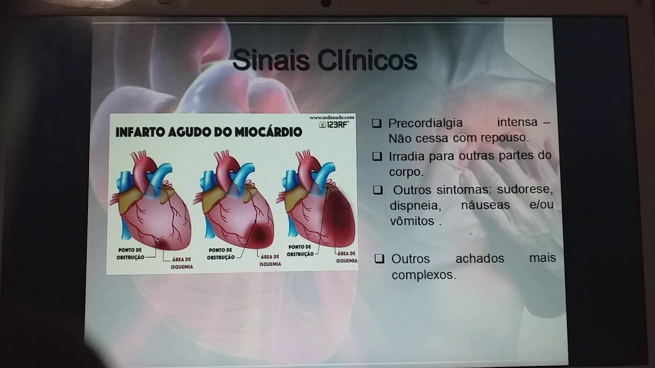 Infarto Agudo do Miocárdio (IAM) - Fisiopatologia e Sinais Clínicos ...