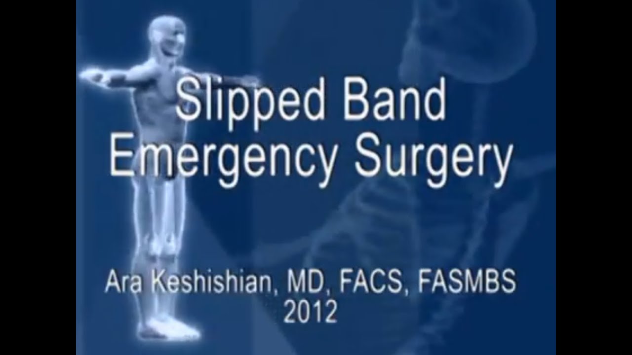 Slipped Adjustable Gastric Band removal - YouTube