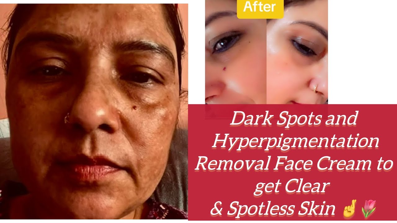 Dark Spots and Hyperpigmentation Removal Face Cream to get Clear ...