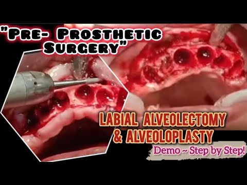 Oral surgeons NEED to KNOW: Reduce Bone height - Alveolectomy ...