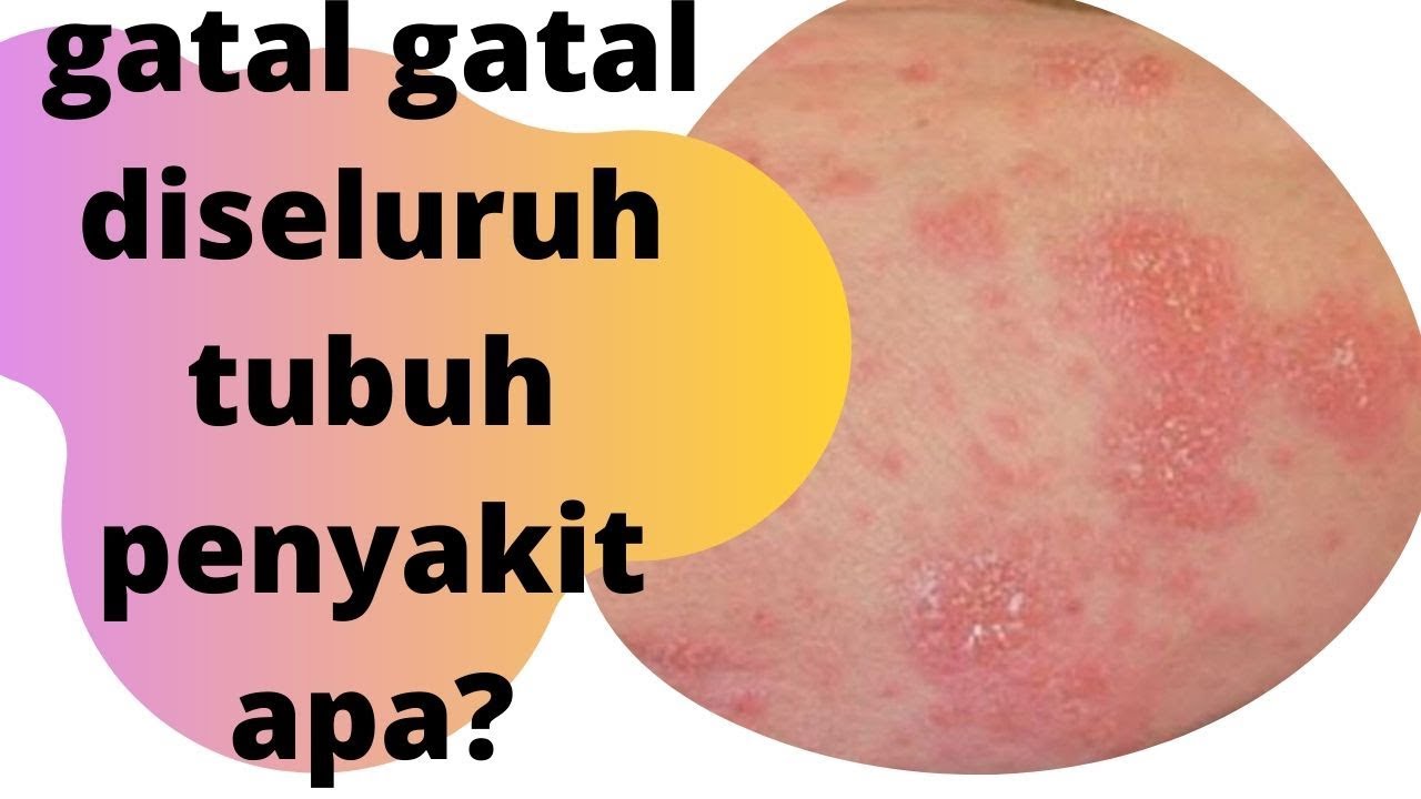 gatal gatal diseluruh tubuh penyakit apa? - YouTube