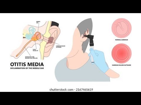 Otitis Media: Definition, Types, Causes, Symptoms, Diagnosis and ...