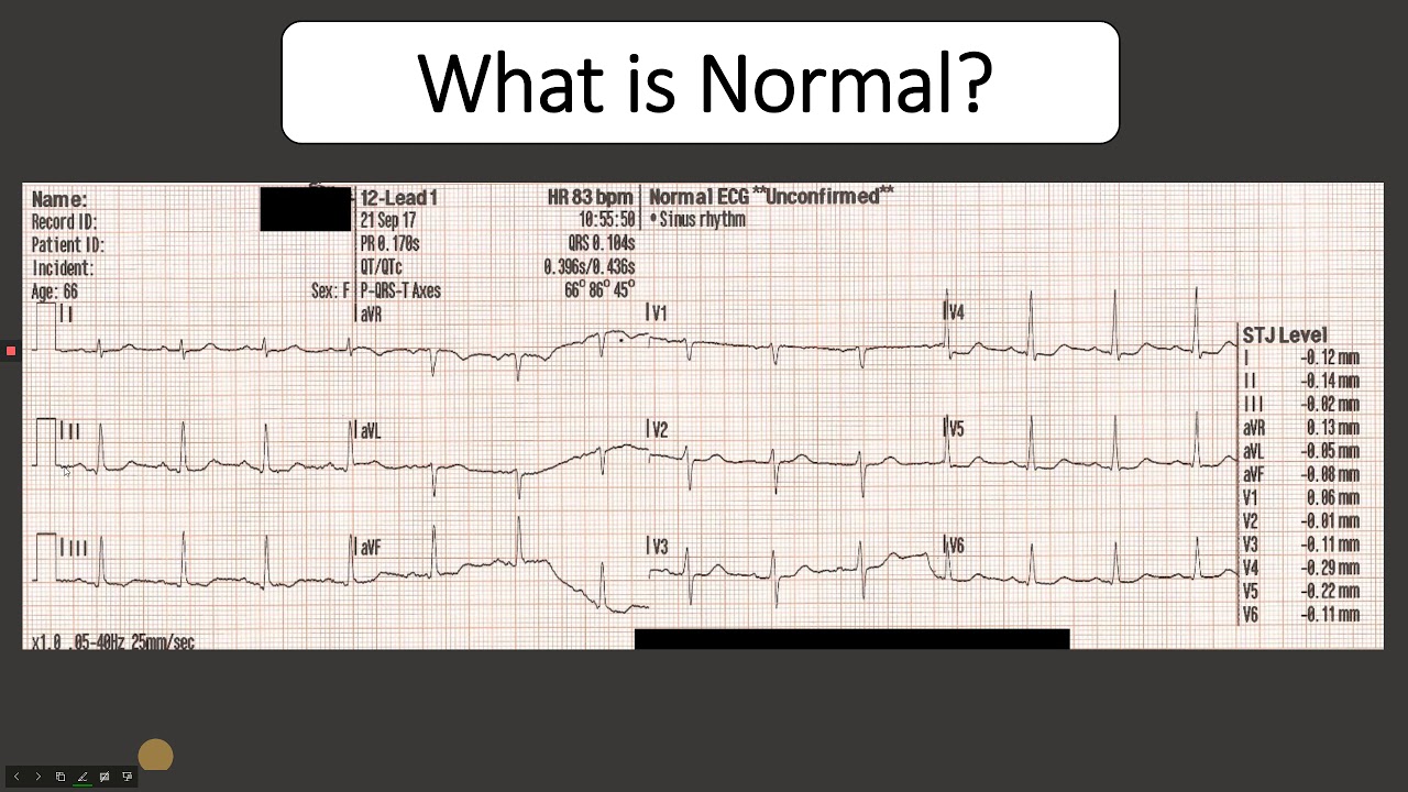 Cardiology 2 - Lecture 1 - A Normal ECG - YouTube
