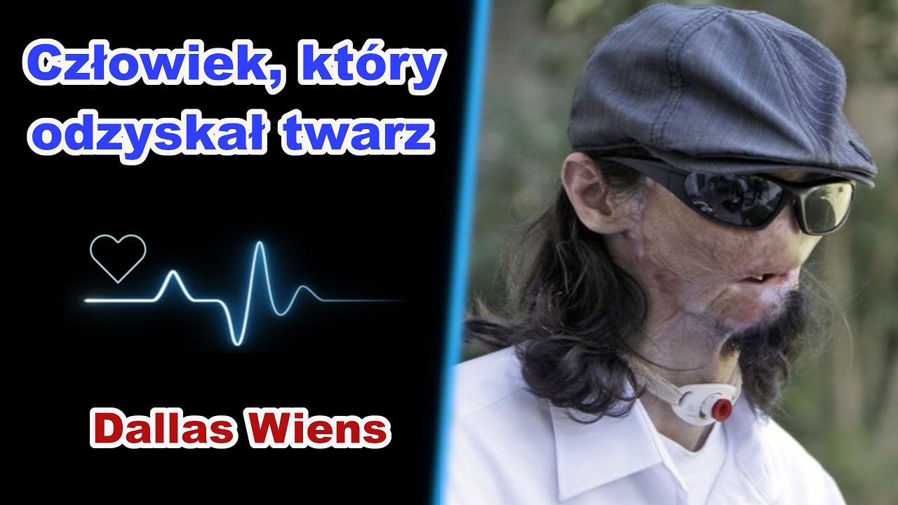 Dallas Wiens - człowiek, który odzyskał twarz - YouTube