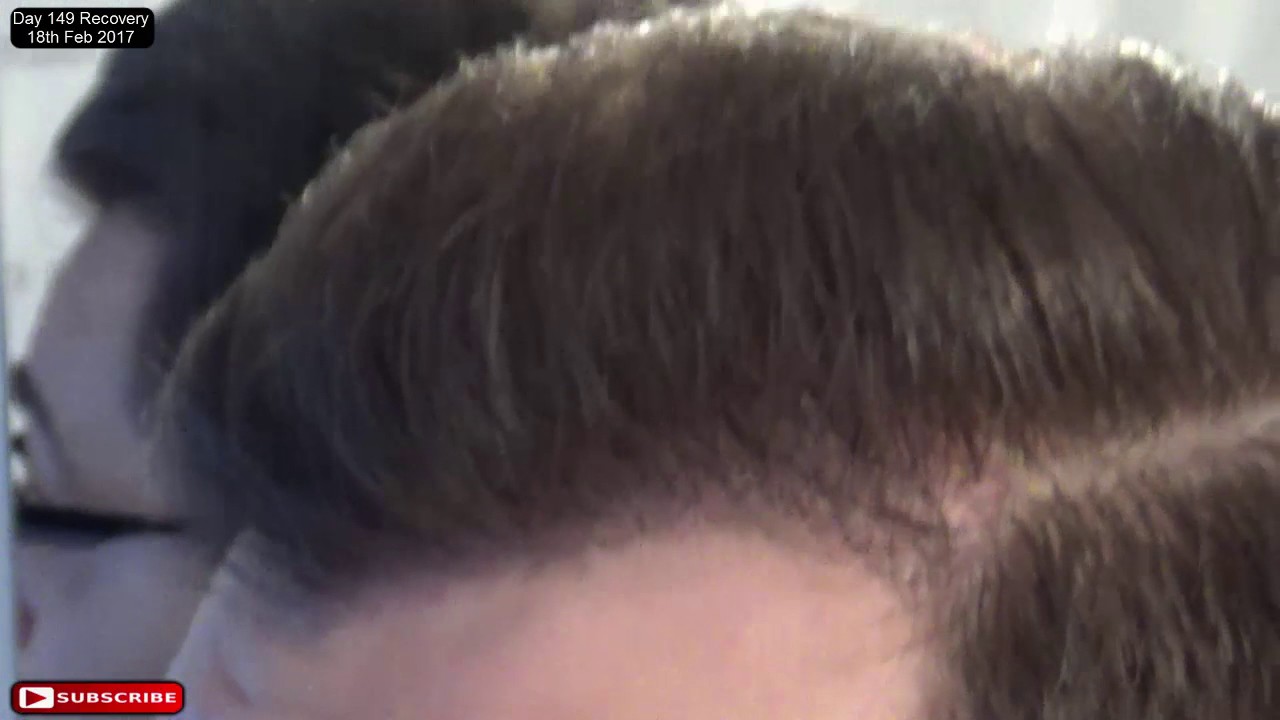 FUE Hair Transplant: Day 149 Post Op Recovery - YouTube