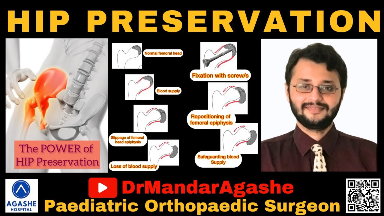 The Power of HIP Preservation for SCFE - YouTube