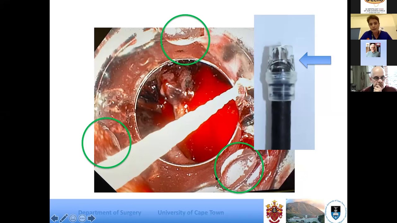 Dr Galya Chinnery - Practical Endotherapy for non variceal bleeding ...