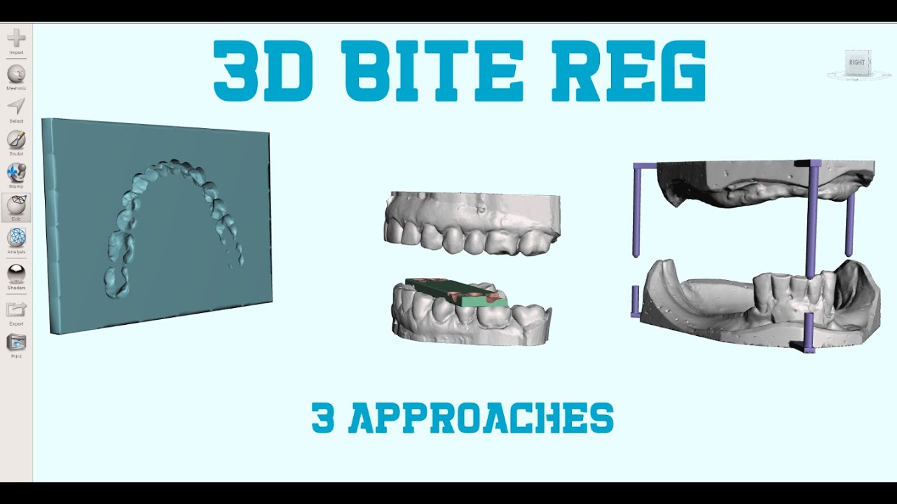 Three Approaches to Maintain a Registered Bite When 3D Printing Dental ...