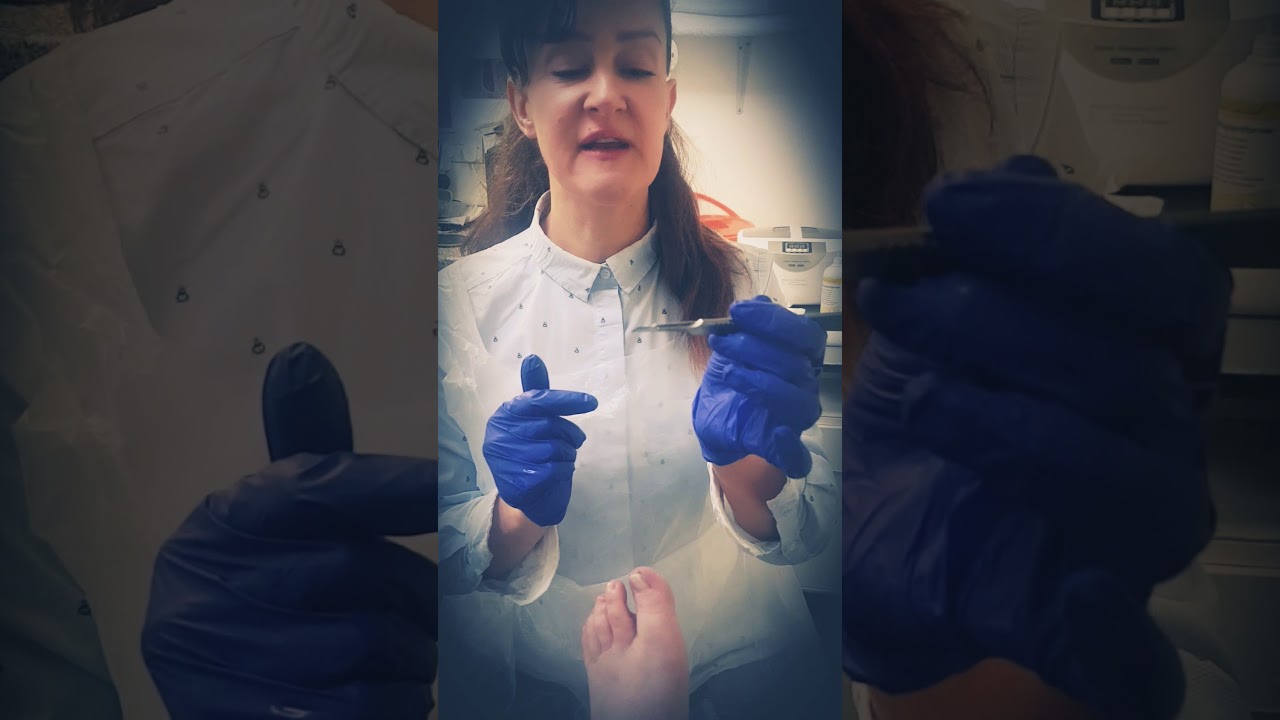 Involuted nails - YouTube