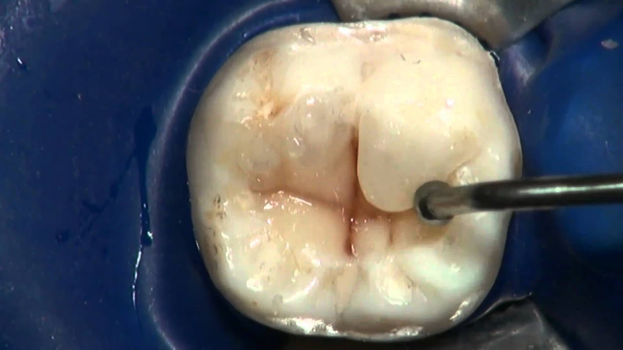 Composite Clase I / Class I - Ultradent Amelogen Plus (A3/EN) - YouTube
