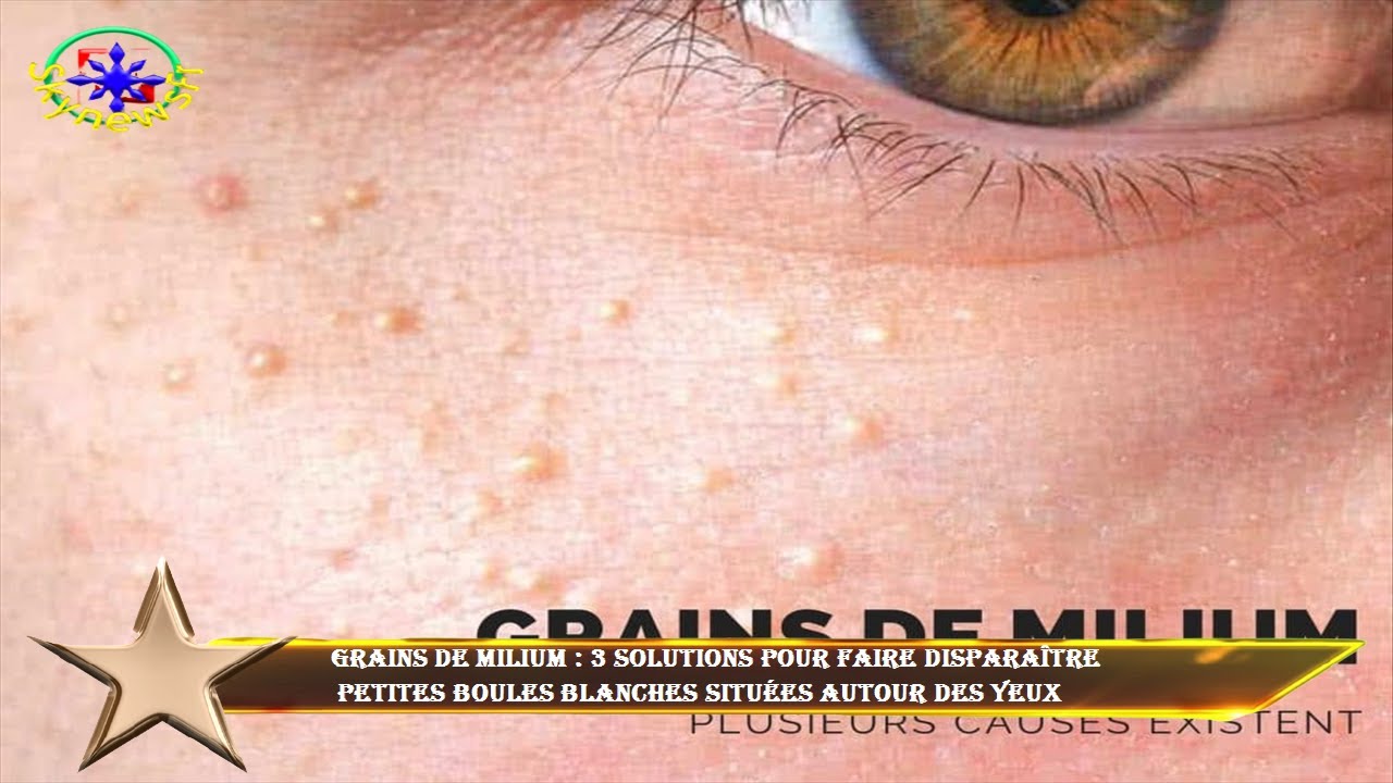 Grains de milium : 3 solutions pour faire disparaître petites boules ...