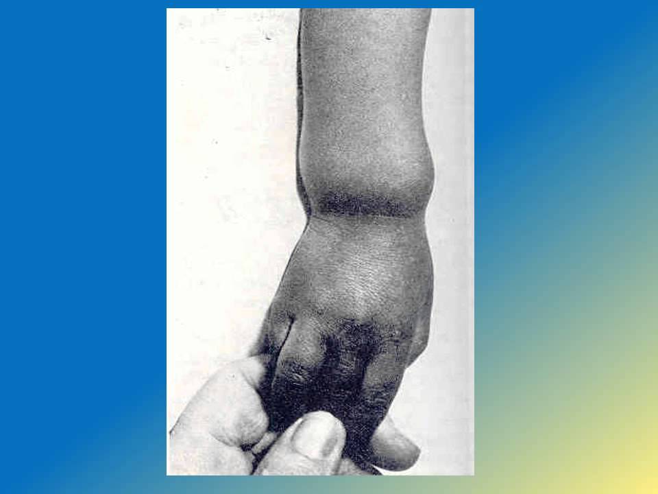 PEDIATRIE Rachitisme Carentiel 2016 - YouTube