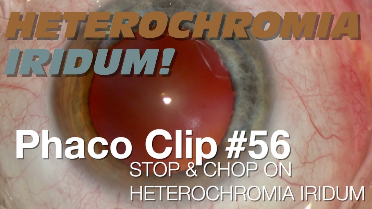 Phaco Clip #56 - Stop & Chop on Heterochromia Iridum - YouTube