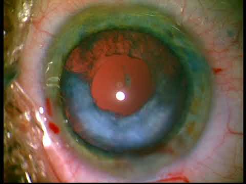 Rupture of the posterior capsule during phaco, management + IOL ...