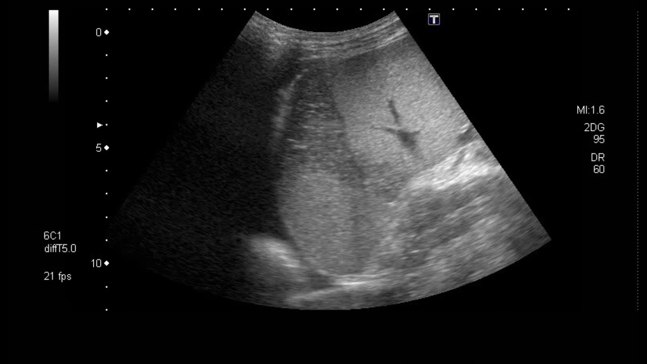 infectious endocarditis and Splenic infarction - YouTube
