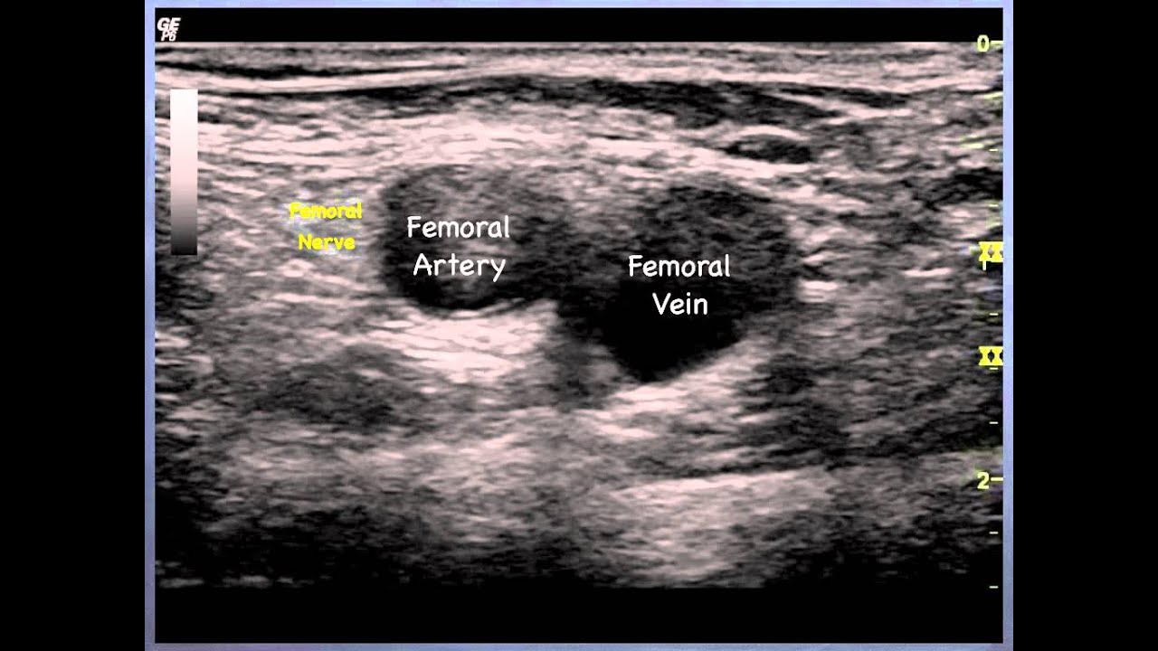 Femoral Nerve (Sonoanatomy) - QMH AED Ultrasound Casebook 2013 (Video ...