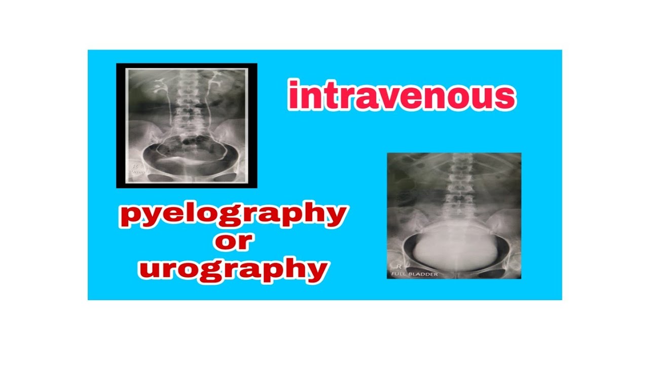 Intravenous Pyelography / Urography (IVP / IVU) - YouTube