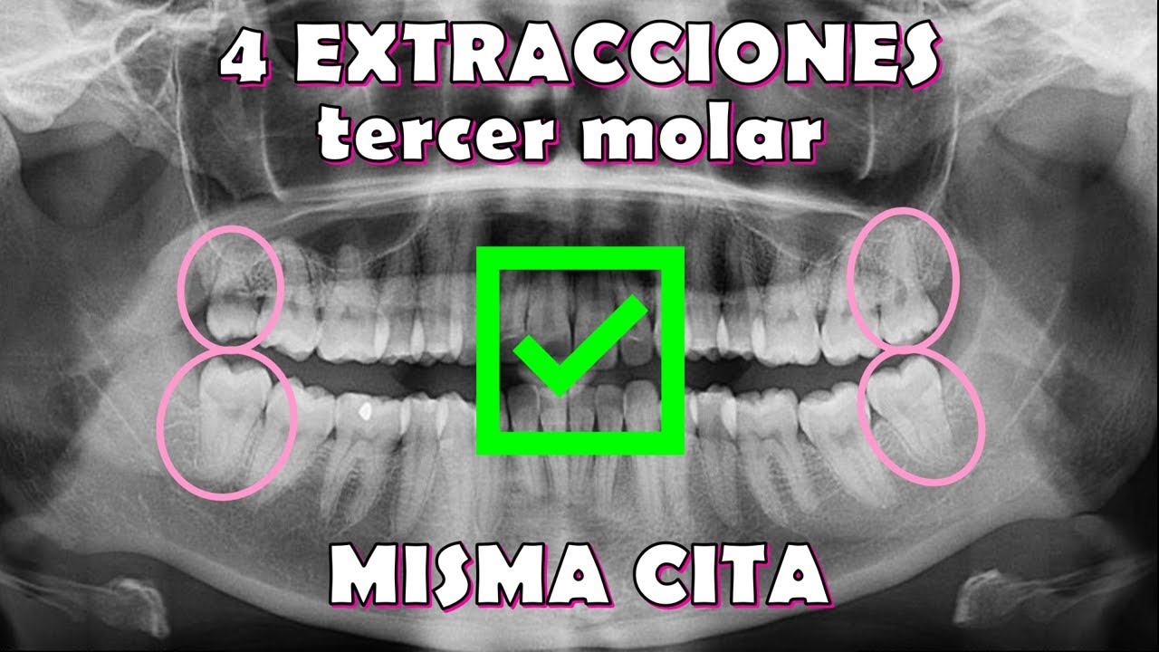 Terceros molares misma cita | Third molars single appointment # ...