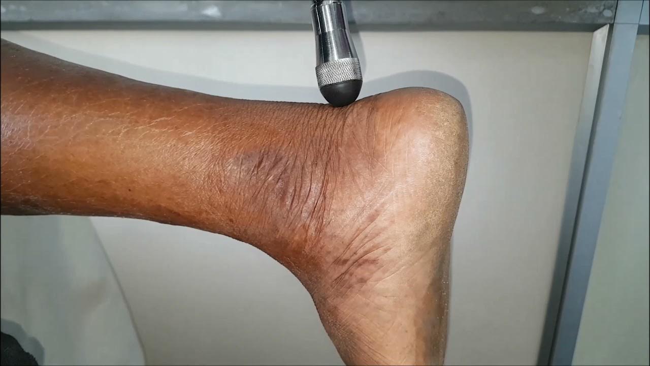 delayed-relaxation-of-ankle-jerk-hypothyroidism-pseudomyotonic-reflex