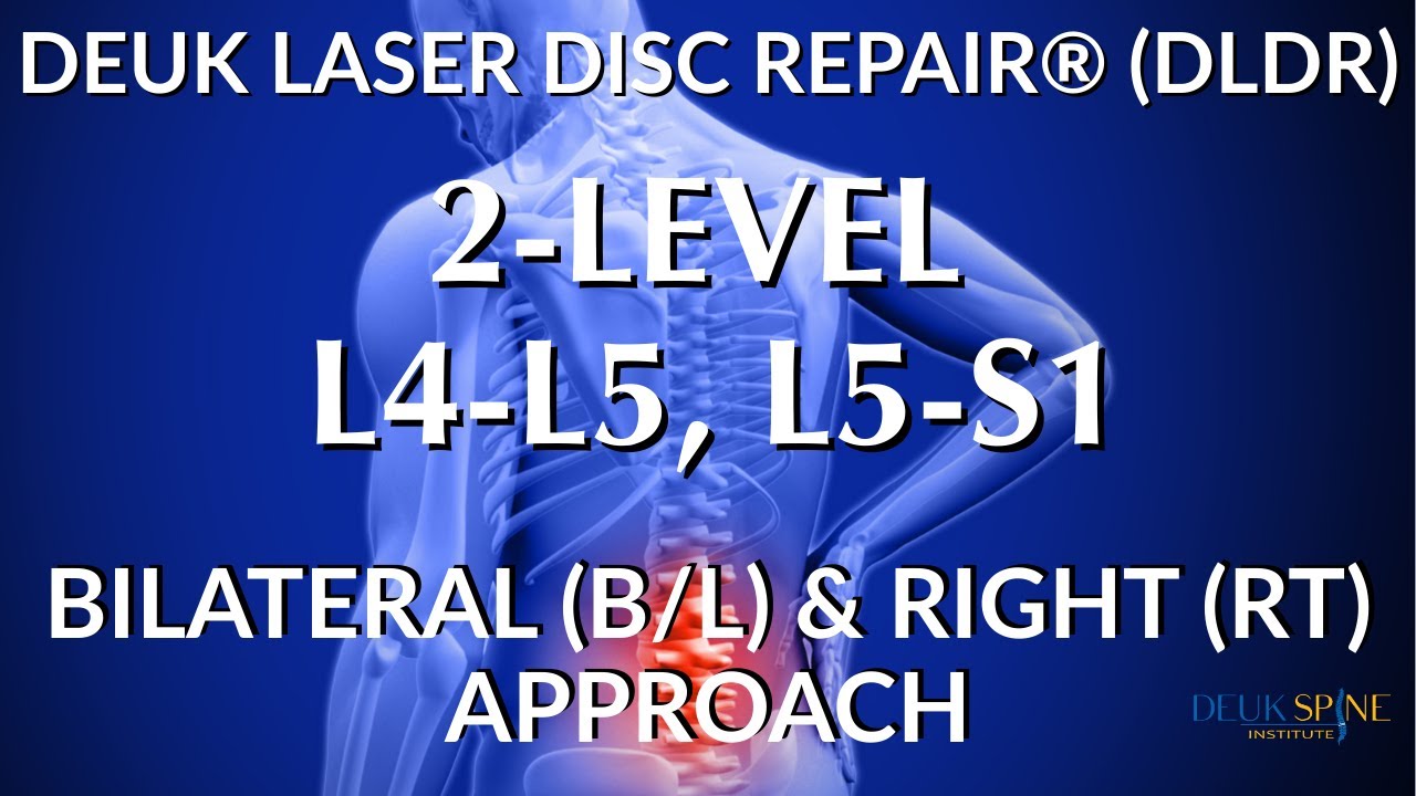 BILATERAL L4-L5, RIGHT L5-S1 HERNIATED DISCS - LIVE - Laser Spine ...