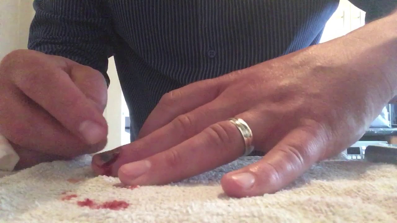 Draining my nail part 2 - YouTube