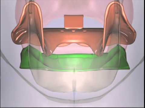 Massad Tray Sizing for Mandibular Impression - YouTube