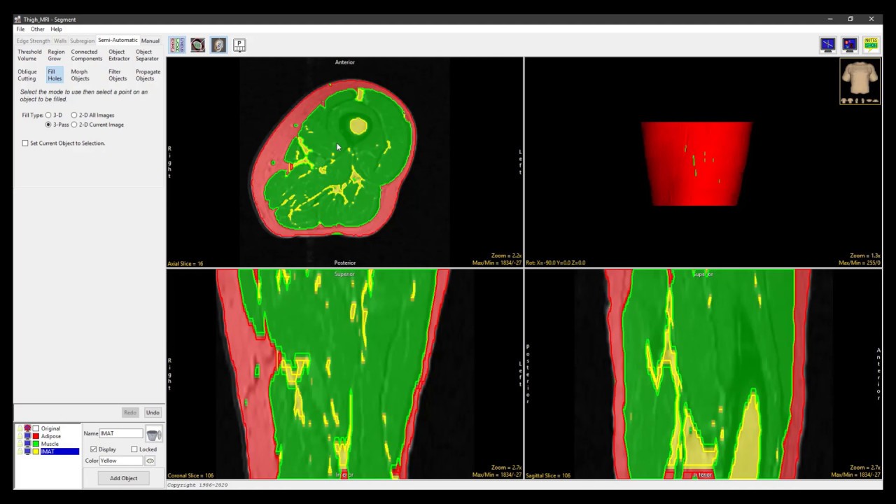 Analyze 14.0 - Segment: Using Fill Holes to Segment Objects - YouTube