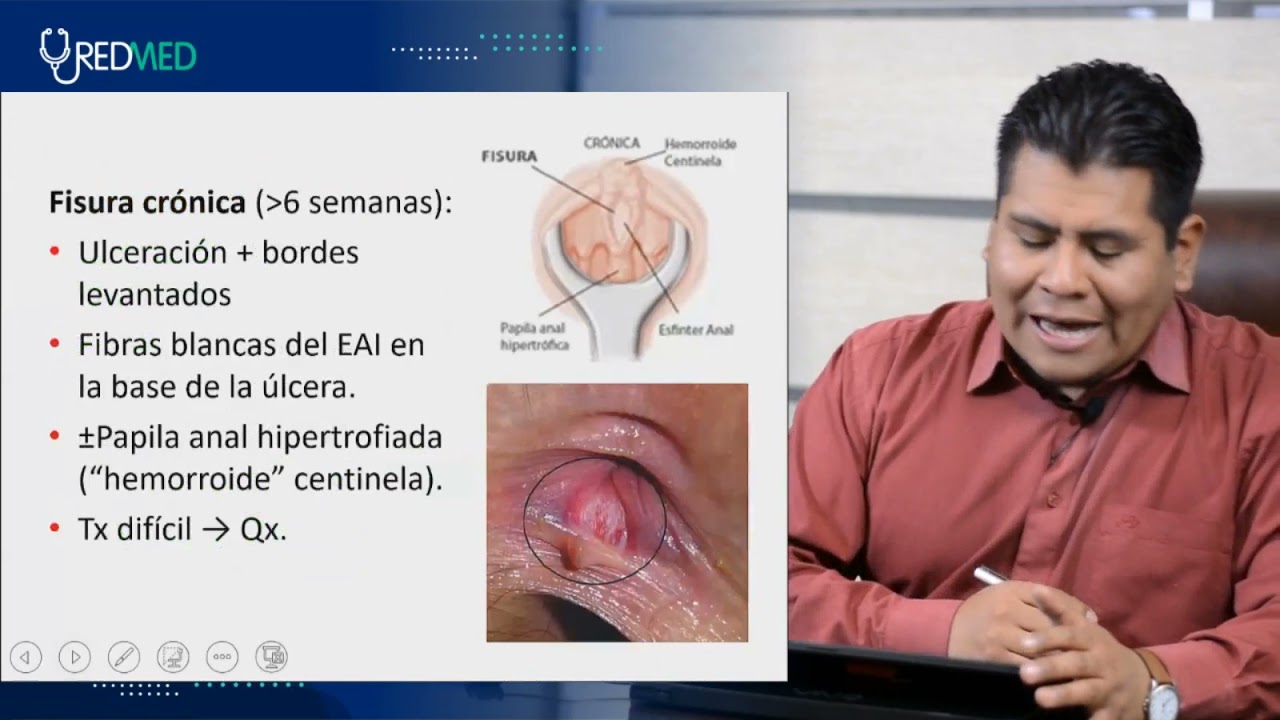 Tema 12 CIRUGIA – Fisuras anorrectales - YouTube
