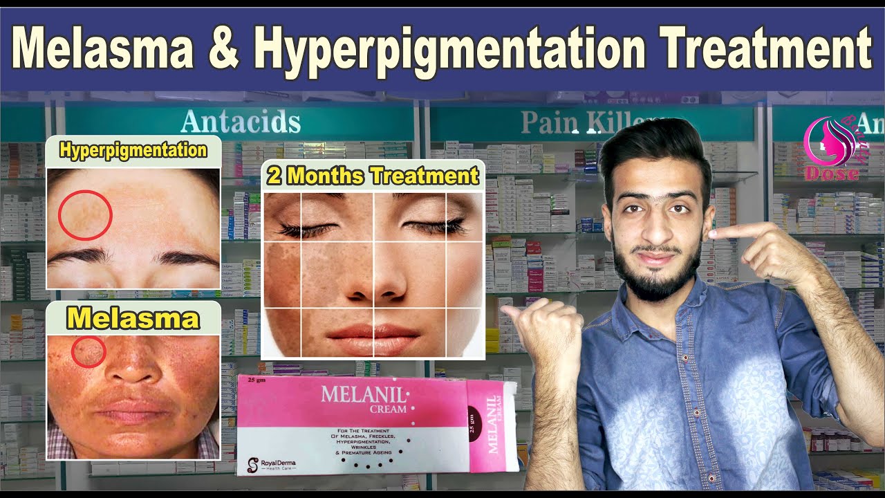 Melanil Cream | How to REMOVE Melasma & Hyperpigmentation | Complete ...