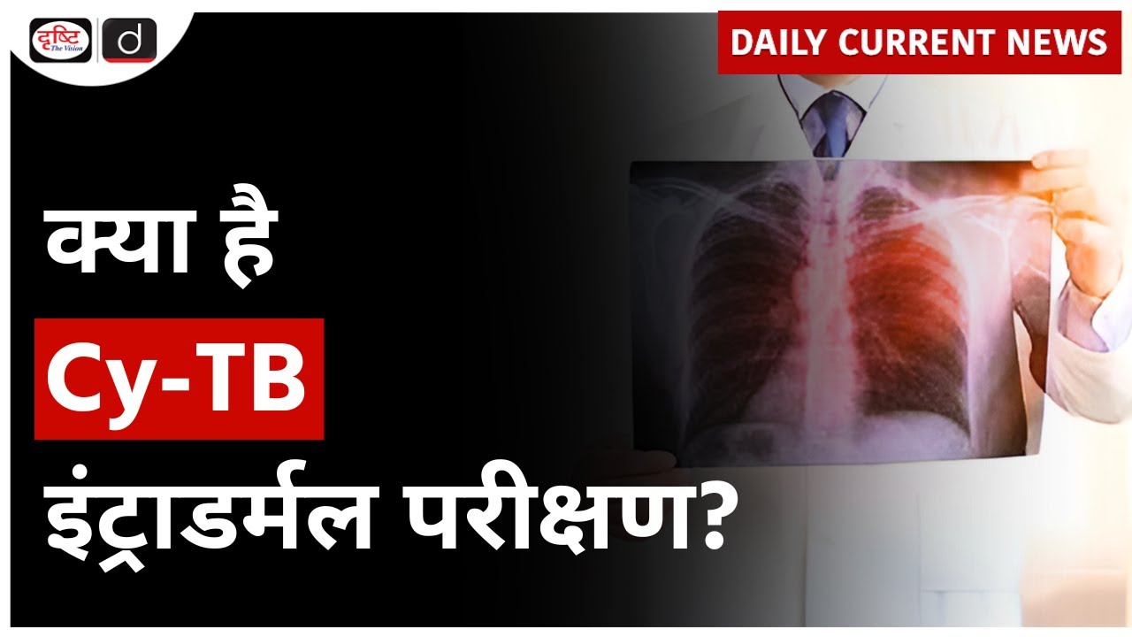 Cy TB Test for Detection of Latent Tuberculosis Infections | Daily ...