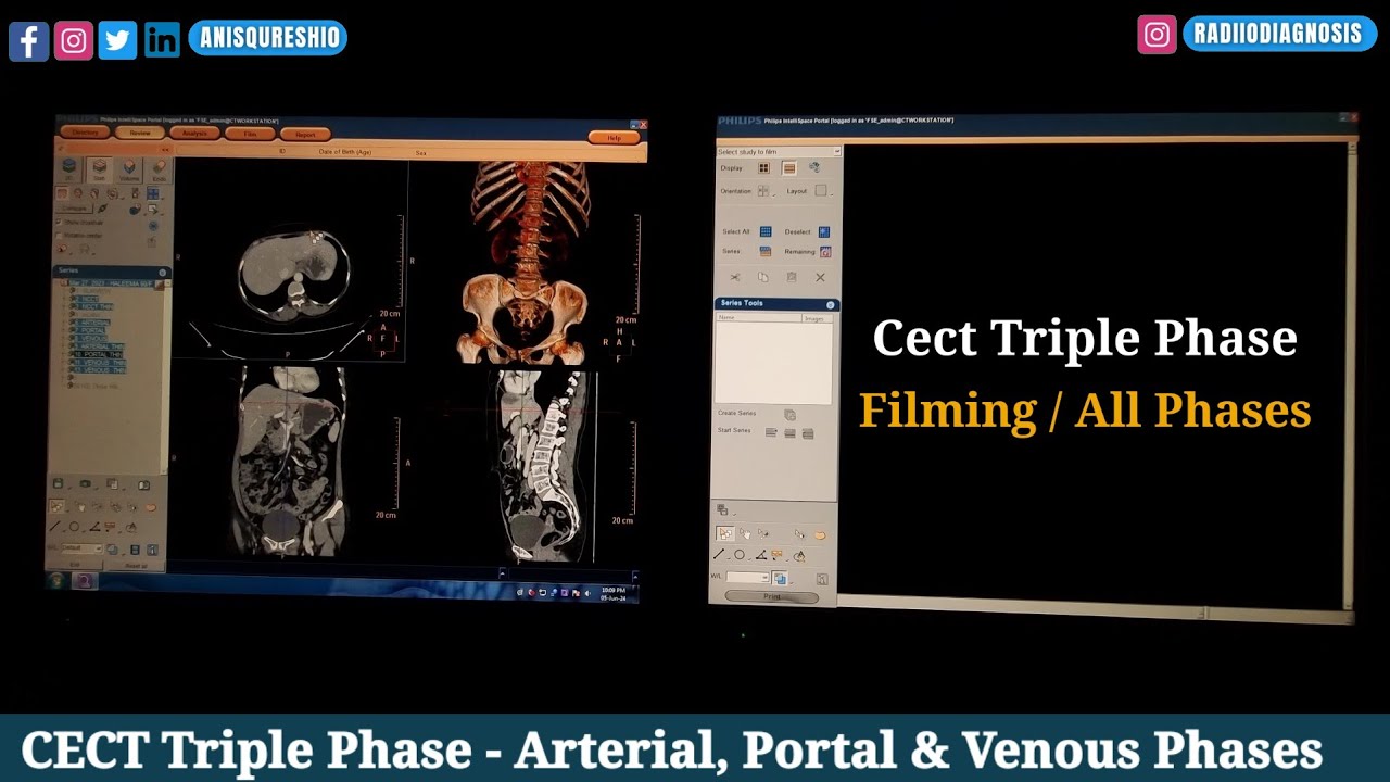 Cect Triple Phase | Arterial, Portal and Venous | By Anis Qureshi - YouTube