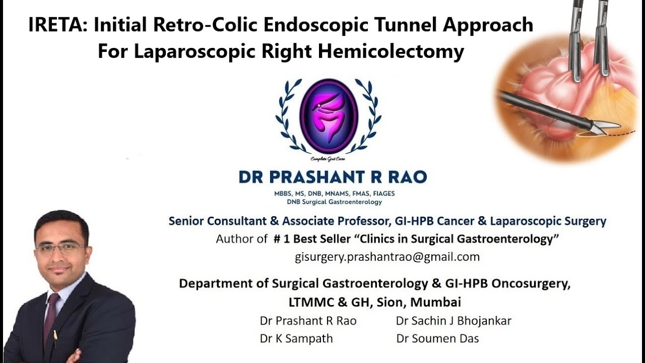 Stepwise Guide to Initial Retrocolic Endoscopic Tunnel Approach (IRETA ...