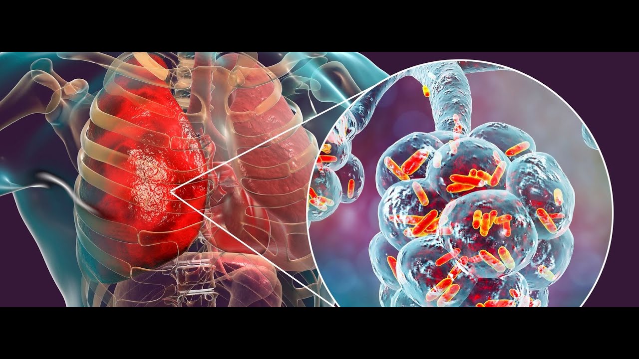 MLBBQ: The lung microbiome regulates brain autoimmunity by Jordan ...