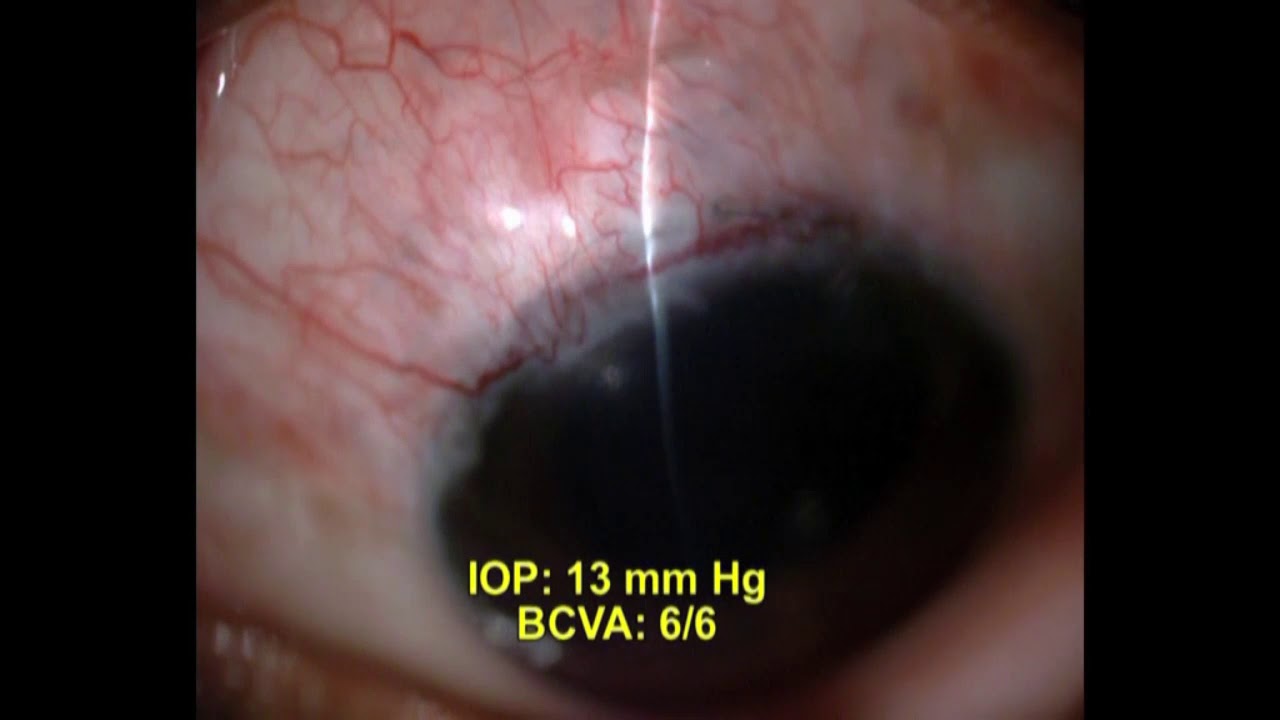 ASCRS 2013 Leaking Blebs Grafts, Patches, and Rotational Flaps - YouTube